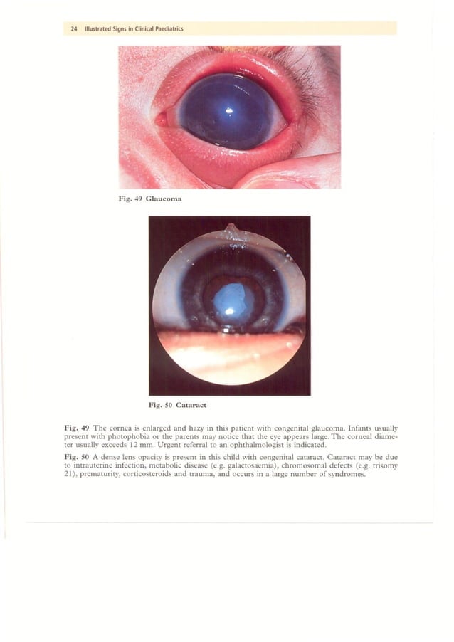 Illustrated signs in clinical pediatrics | PDF