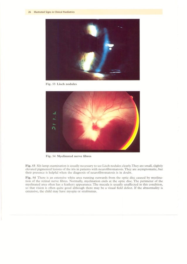 Illustrated signs in clinical pediatrics | PDF