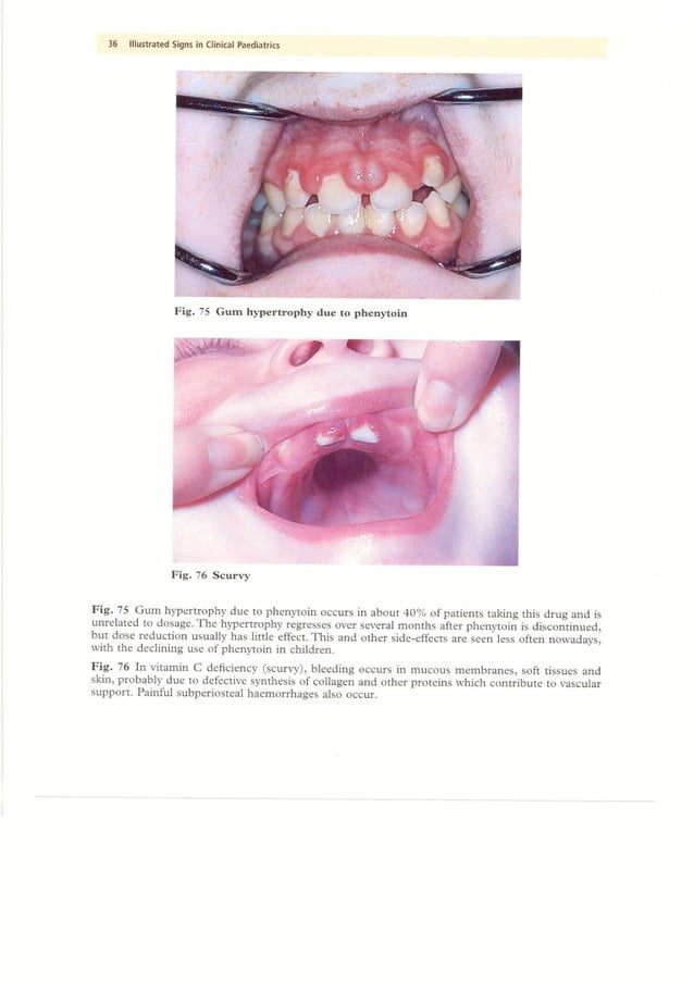 Illustrated signs in clinical pediatrics | PDF