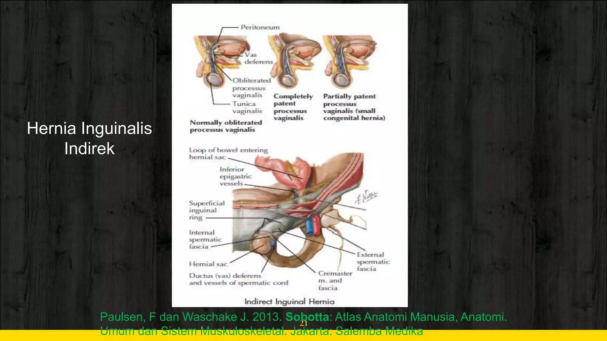 Hernia dan Hidrokel | PPT