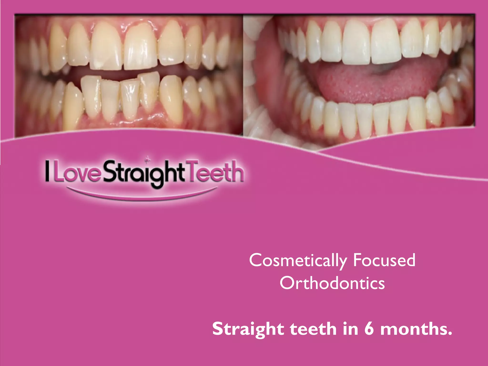Guide to straight teeth in 6 months | PDF