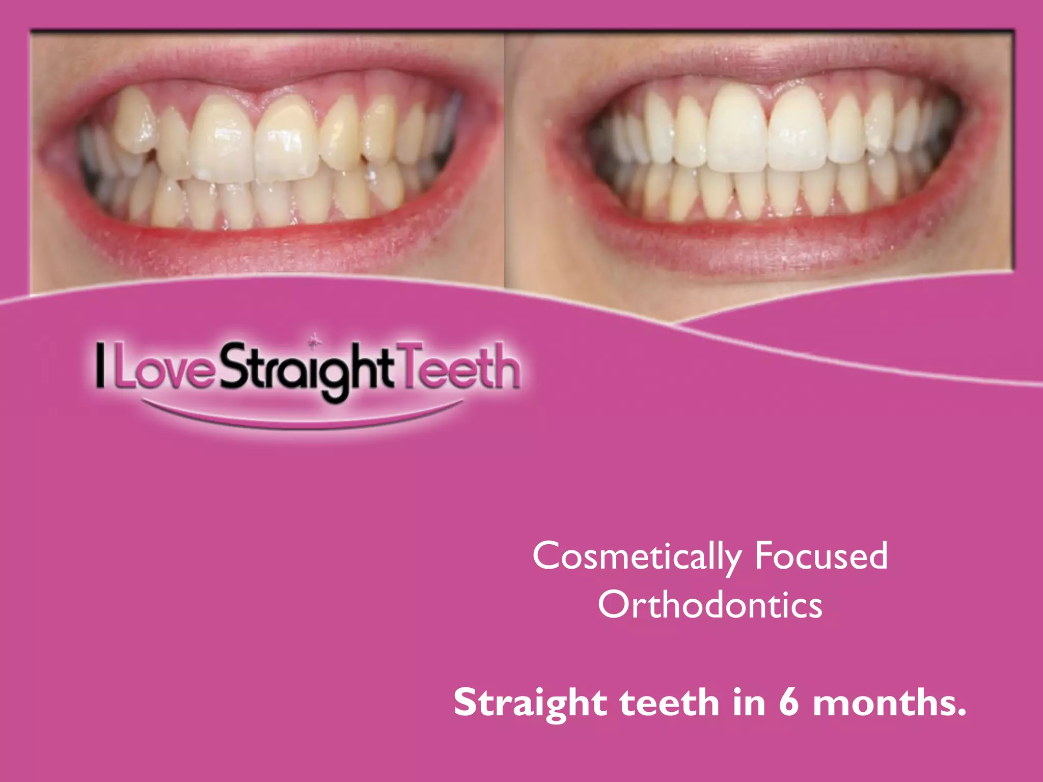 Guide to straight teeth in 6 months | PDF