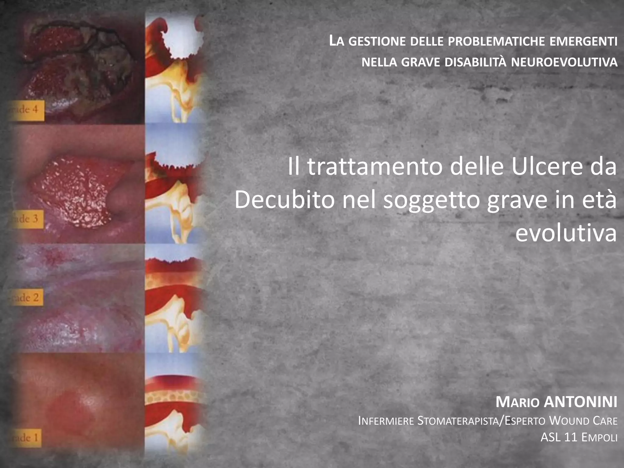 Il trattamento delle ulcere da decubito nel soggetto grave in età ...