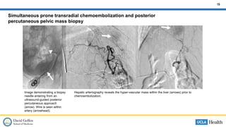 PCI & AimRadial 2018 | Prone Transradial Access: Approach and Uses ...
