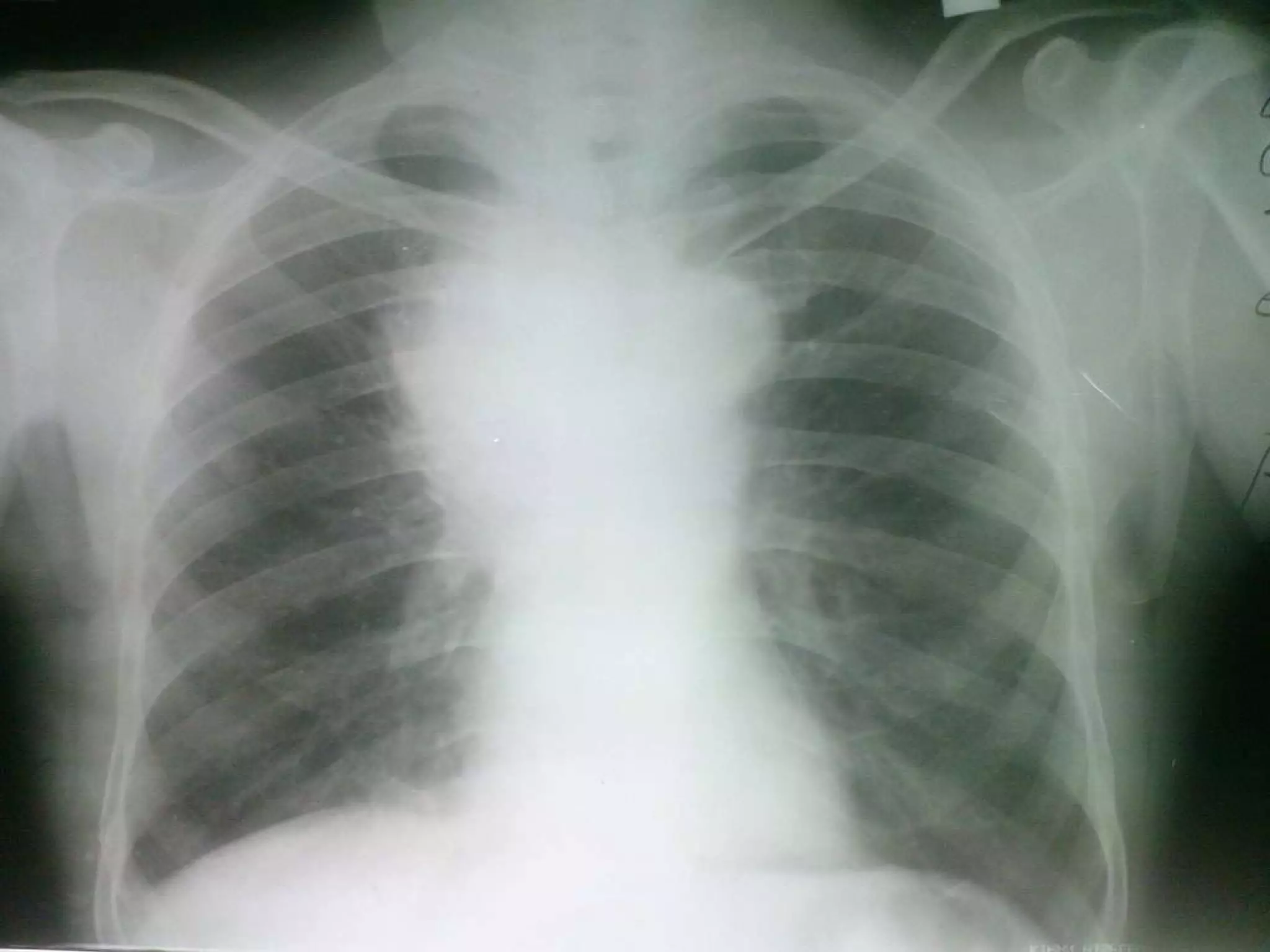 CXR: Superior vena caval syndrome | PPT