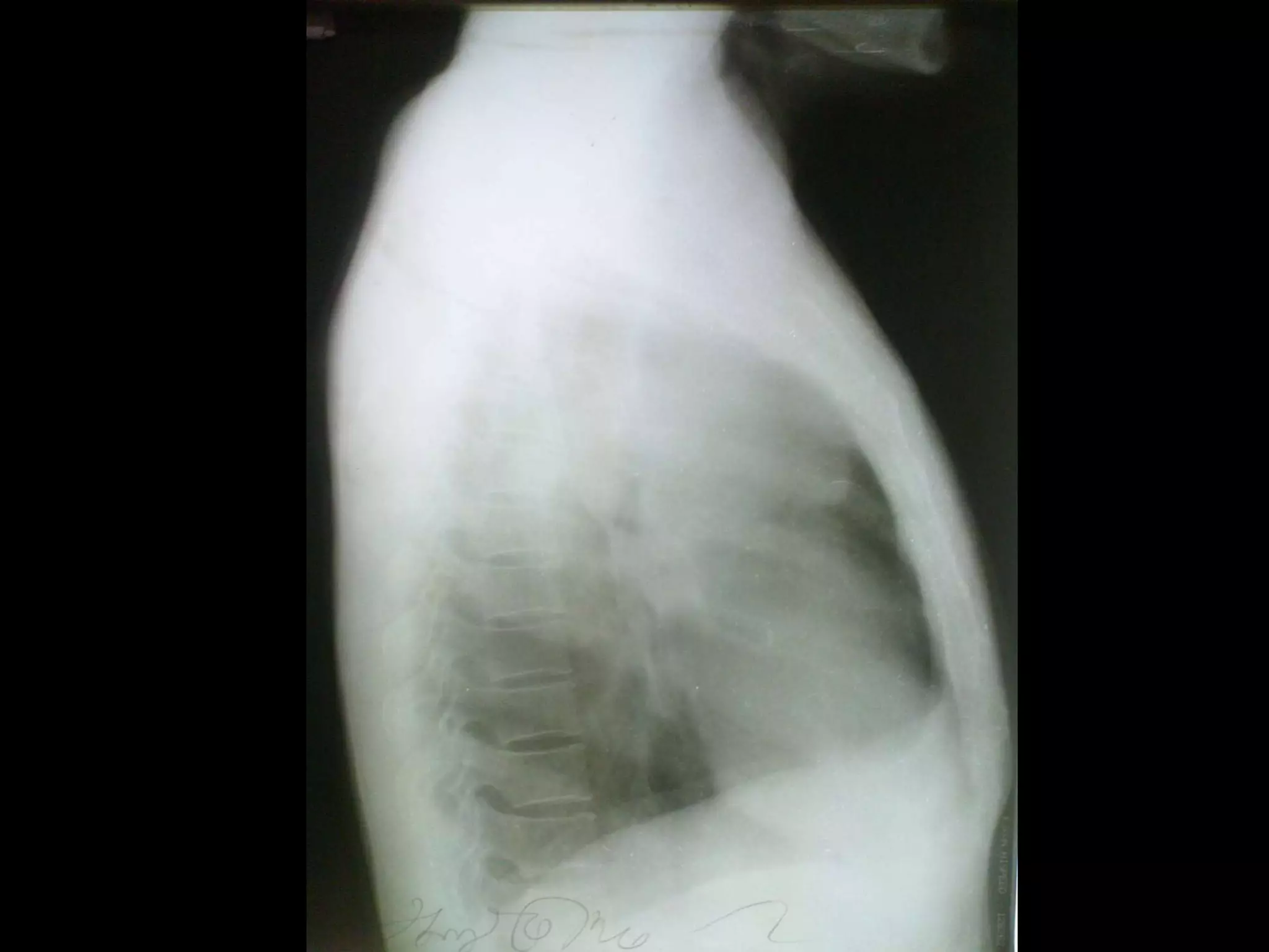 CXR: Superior vena caval syndrome | PPT