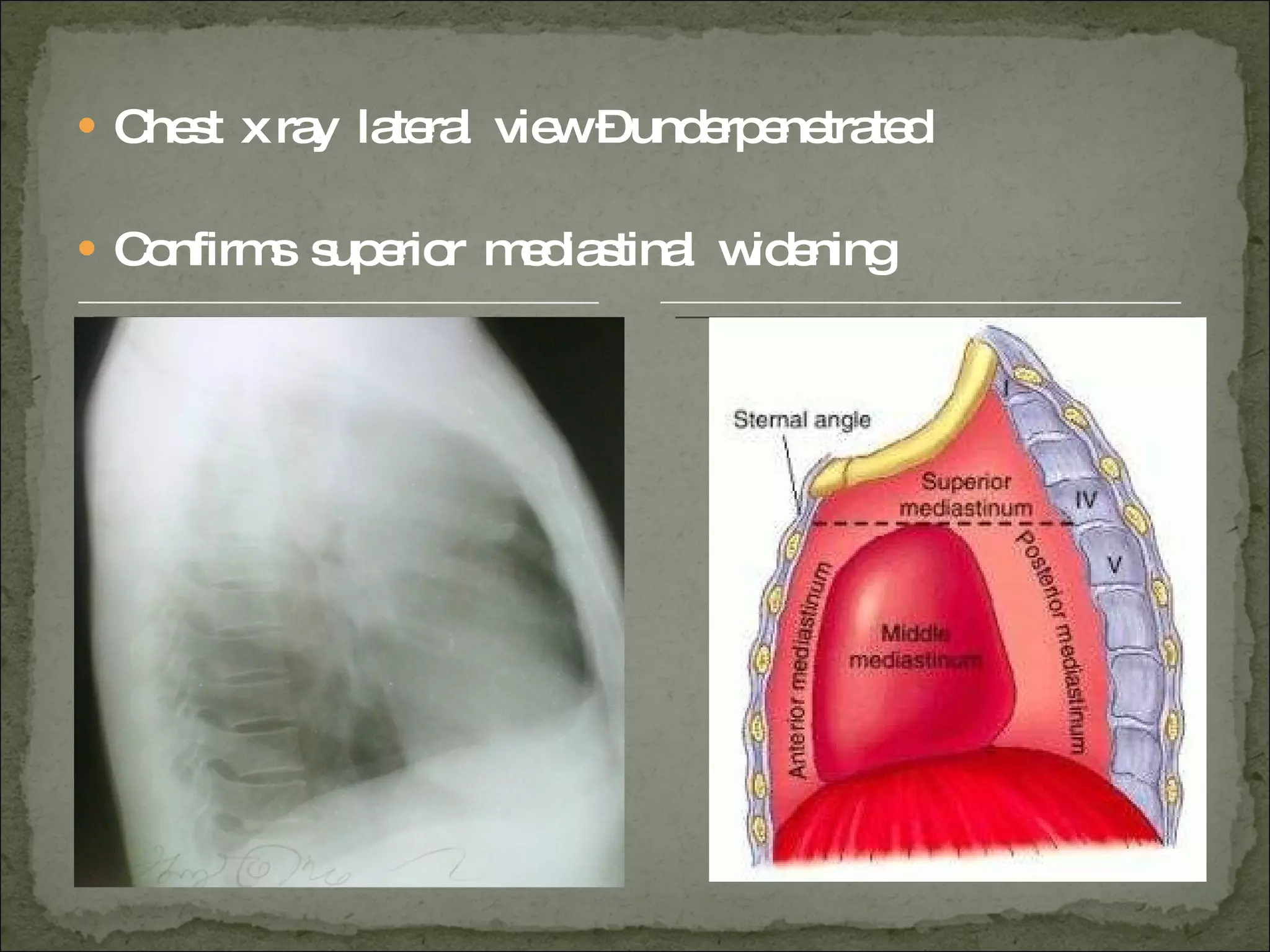 CXR: Superior vena caval syndrome | PPT