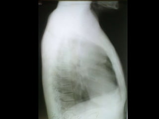 CXR: Superior vena caval syndrome | PPT