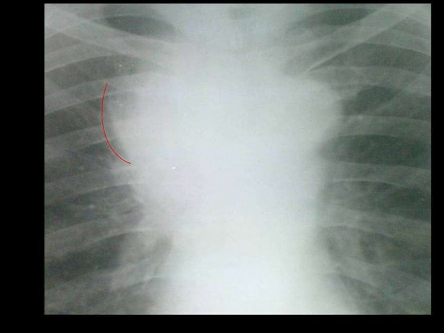 CXR: Superior vena caval syndrome | PPT