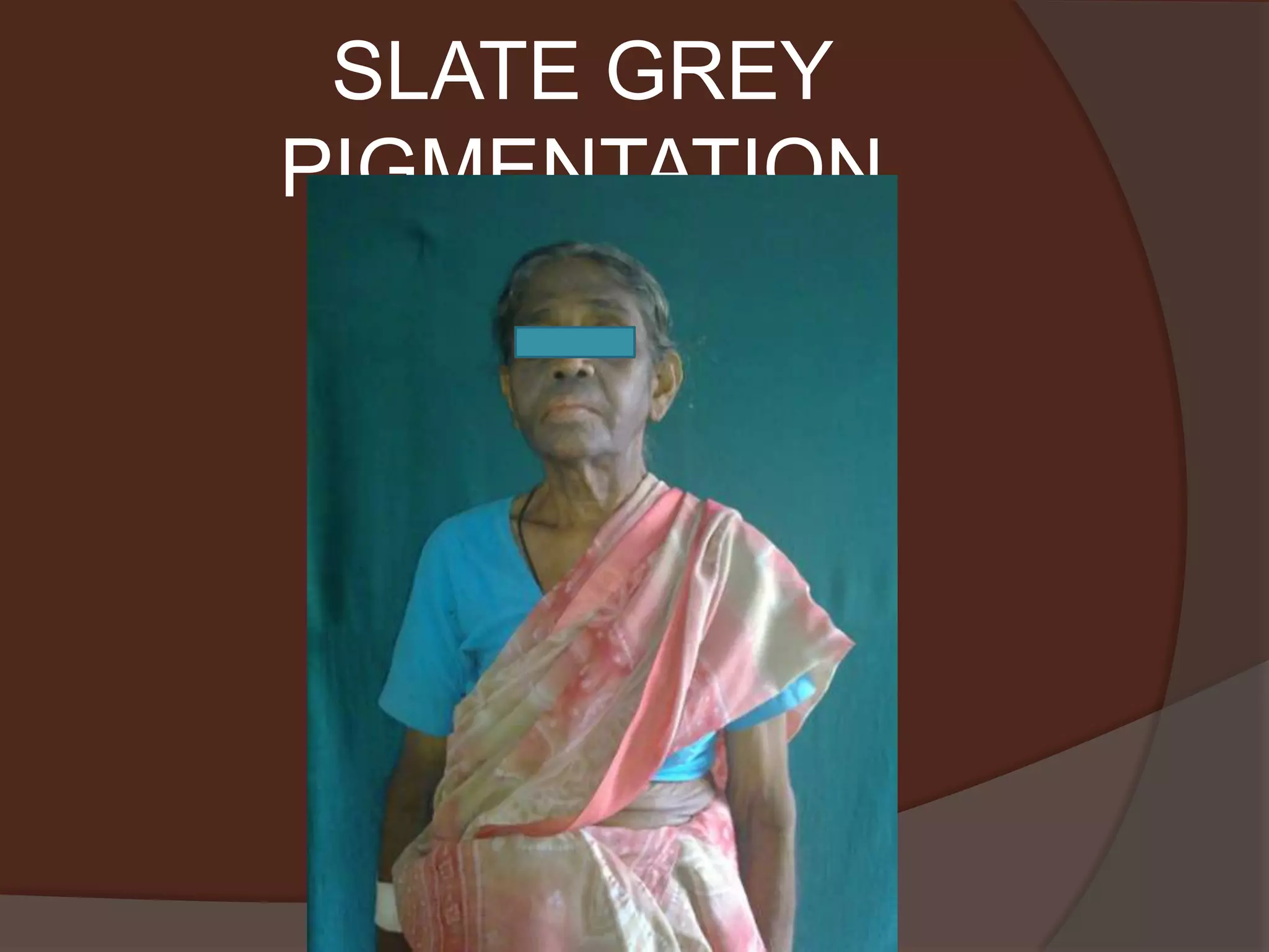 X RAY EGG SHELL CALCIFICTION | PPT