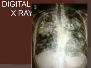 X RAY EGG SHELL CALCIFICTION | PPT