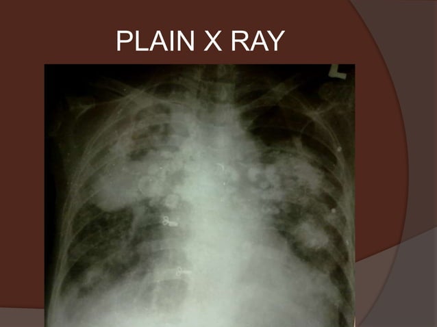 X RAY EGG SHELL CALCIFICTION | PPT