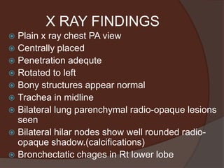 X RAY EGG SHELL CALCIFICTION | PPT