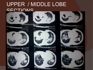 X RAY EGG SHELL CALCIFICTION | PPT