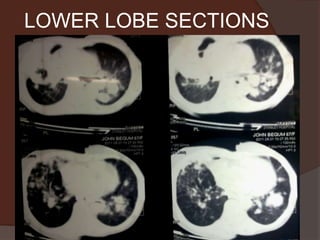 X RAY EGG SHELL CALCIFICTION | PPT