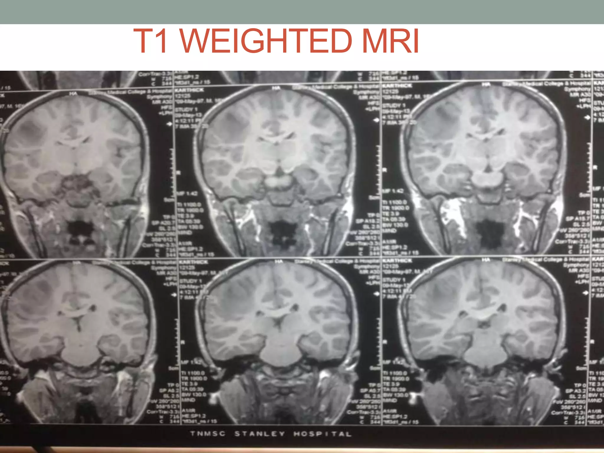 IMAGING: NEUROCYSTICERCOSIS | PPTX