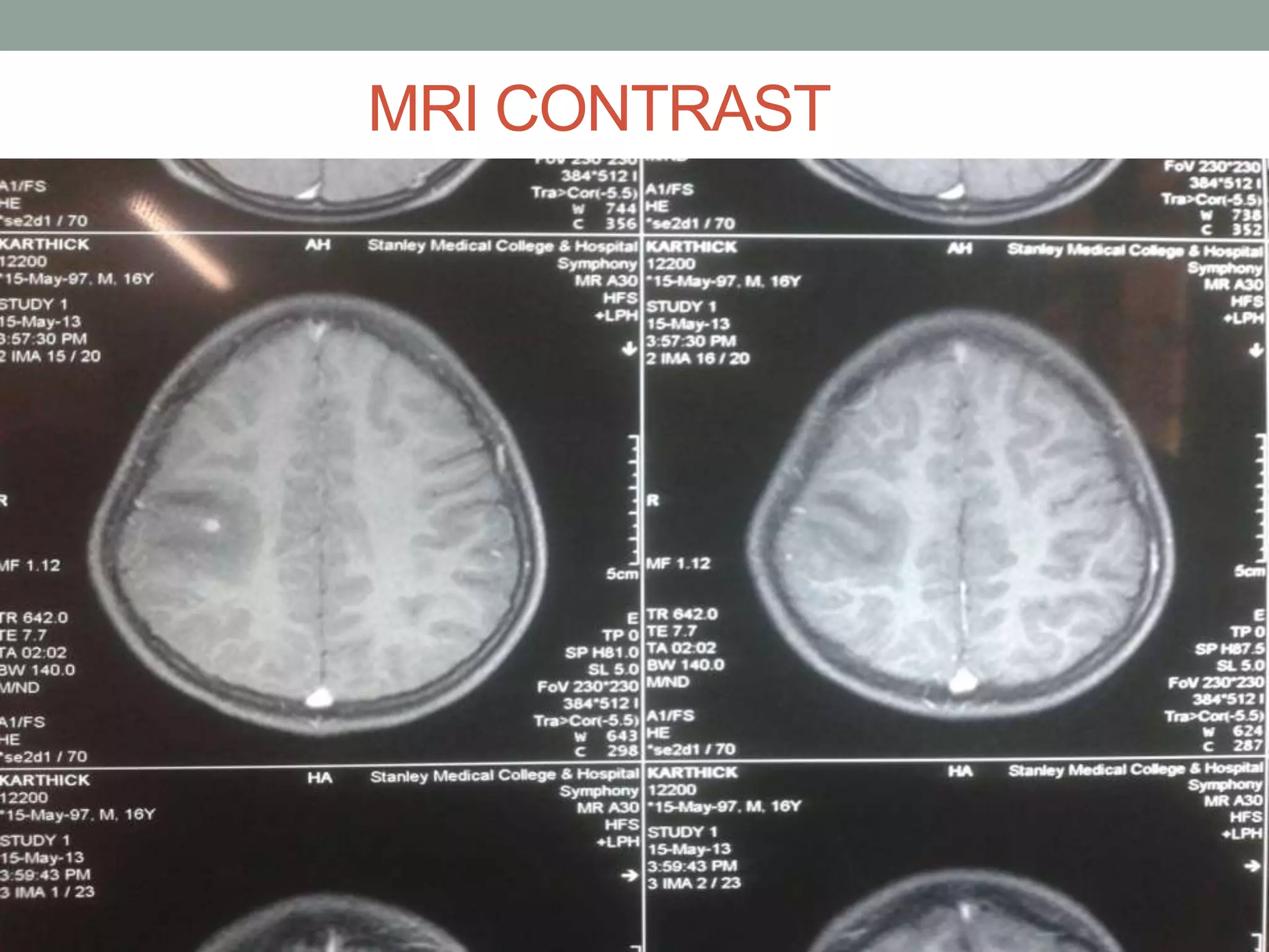 IMAGING: NEUROCYSTICERCOSIS | PPTX