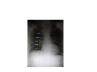 CXR: Coarctation of Aorta | PPT