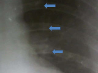 CXR: Coarctation of Aorta | PPT