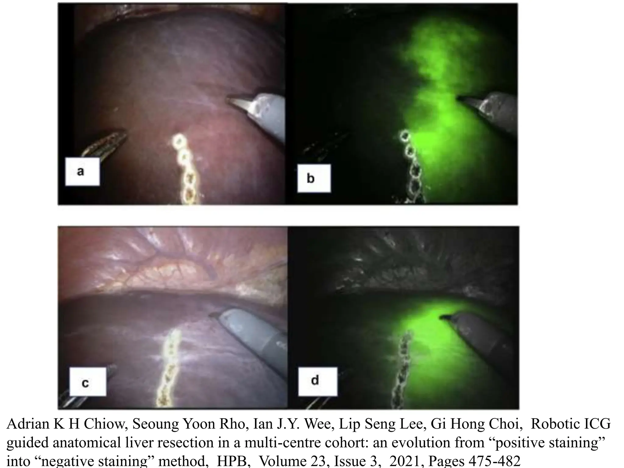Role of Image guidance in THE HPB surgery.pptx