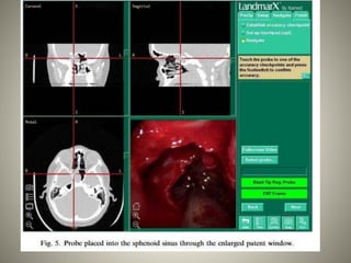 Image Guided ESS | PPTX