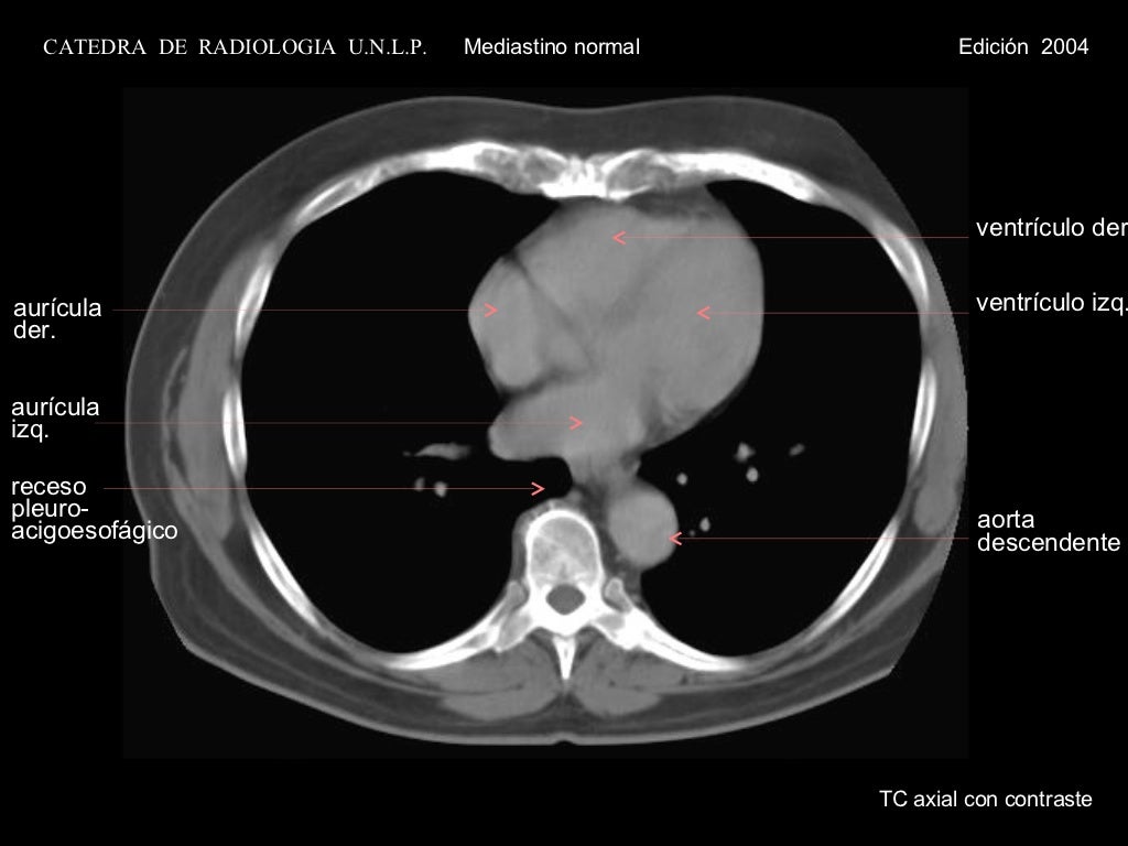 Imagenes Normales De Torax