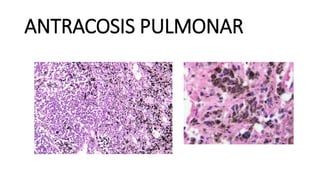 Imagenes patologia cardiovascular pulmonar y respiratorio | PPT