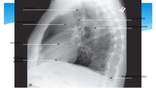 Imagenes radiografia torax | PPTX