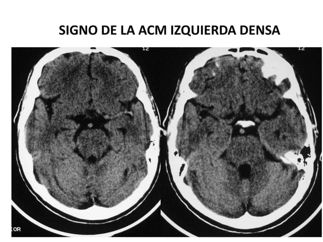 Imagenología Integral Del Ictus Isquémico Con Tc Multidetector