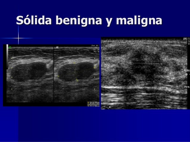 Imagenologia De La Mama