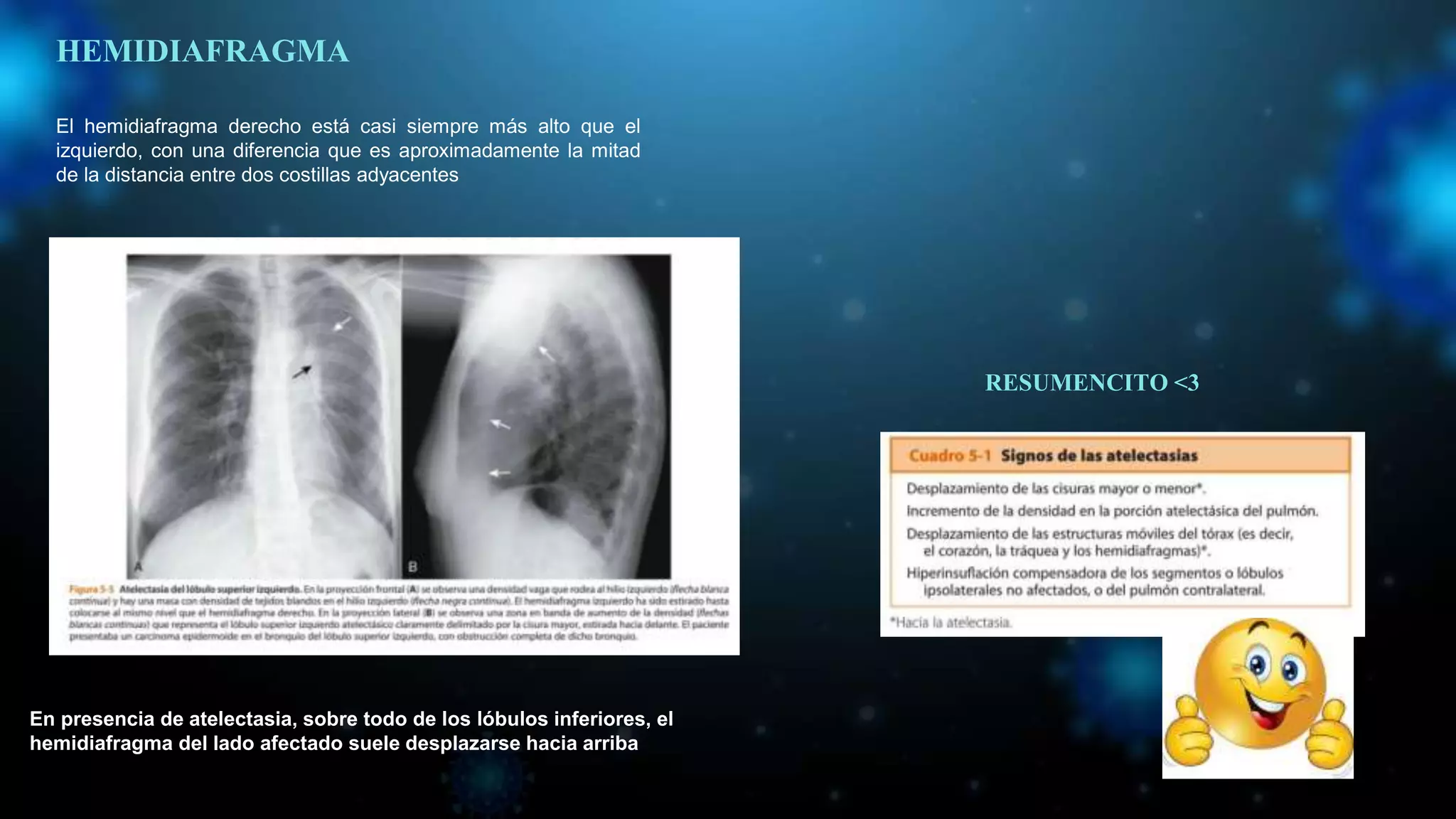Imagenologia Atelectasias y Neumonía.pptx