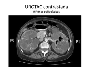 IMAGENOLOGIA DEL SISTEMA RENAL 2022.pptx