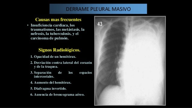 Imagenologia derrame pleural