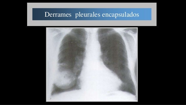 Imagenologia derrame pleural