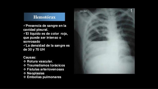 Imagenologia derrame pleural