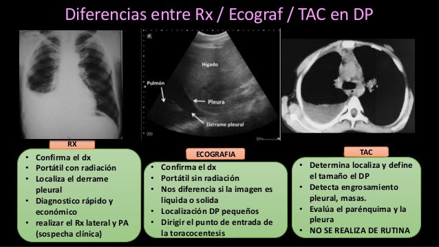 Imagenologia derrame pleural