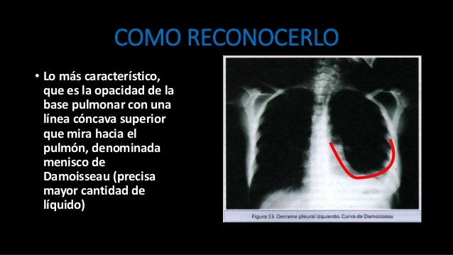 Imagenologia derrame pleural