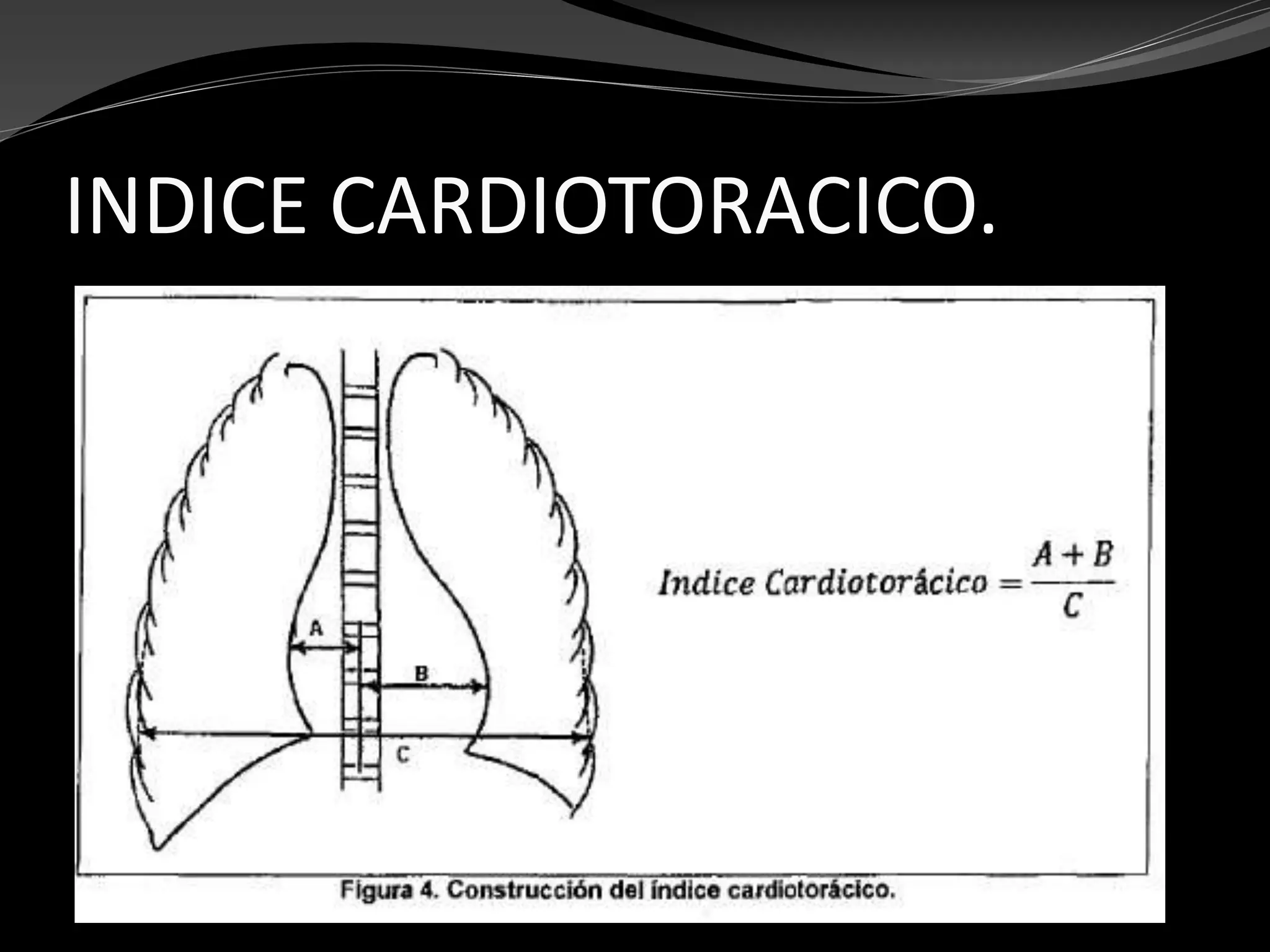 IMAGENOLOGIA ICT Y GRADOS DE CARDIOMEGALIA