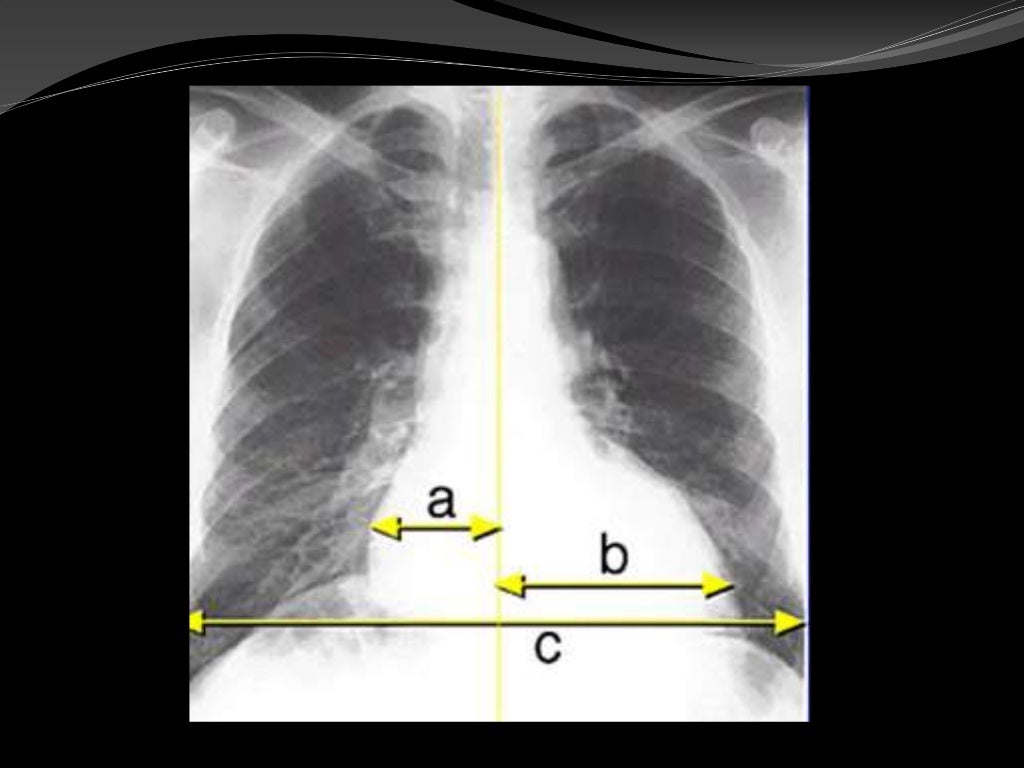 IMAGENOLOGIA ICT Y GRADOS DE CARDIOMEGALIA