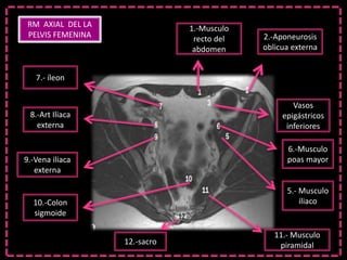Imagenologia pelvis | PPTX
