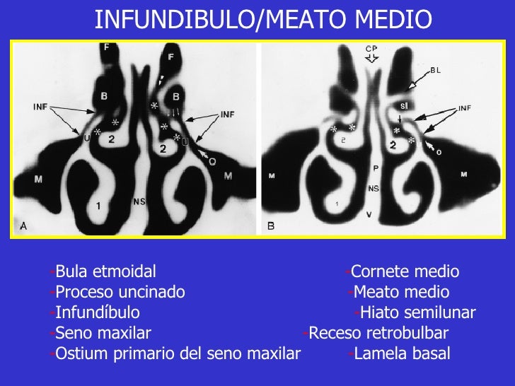 Senos Paranasales Imagenología