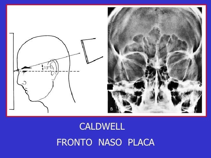 Senos Paranasales Imagenología