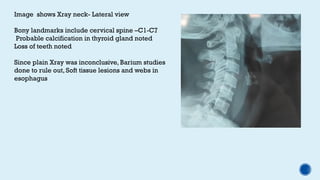 IMAGE OF THE DAY PLUMMER VINSON SYNDROME | PPTX