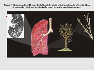 Imaging: Endobronchial TB | PPT