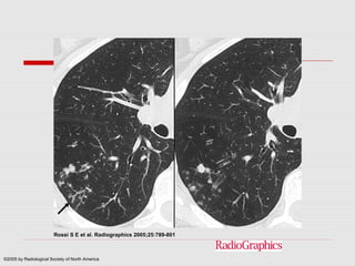 Imaging: Endobronchial TB | PPT