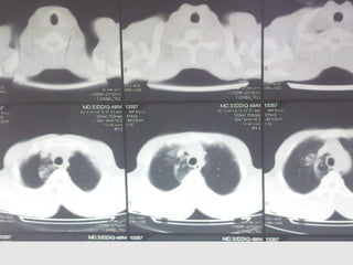 Imaging: Endobronchial TB | PPT