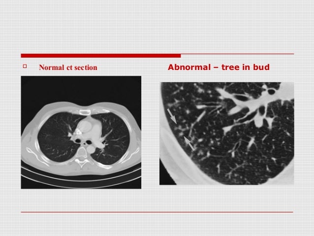 Imaging: Endobronchial TB