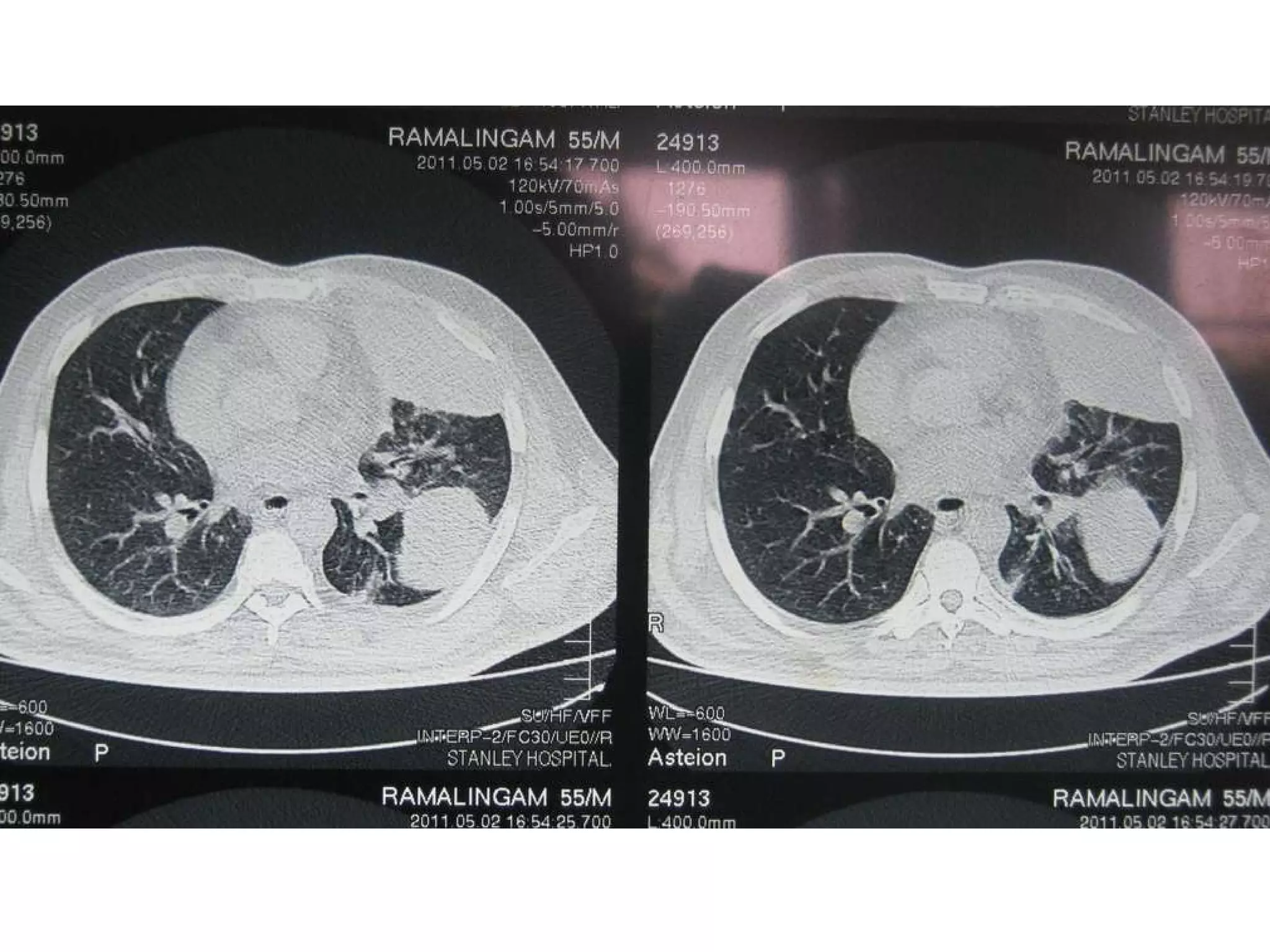 CT Chest: Lung abscess | PPT
