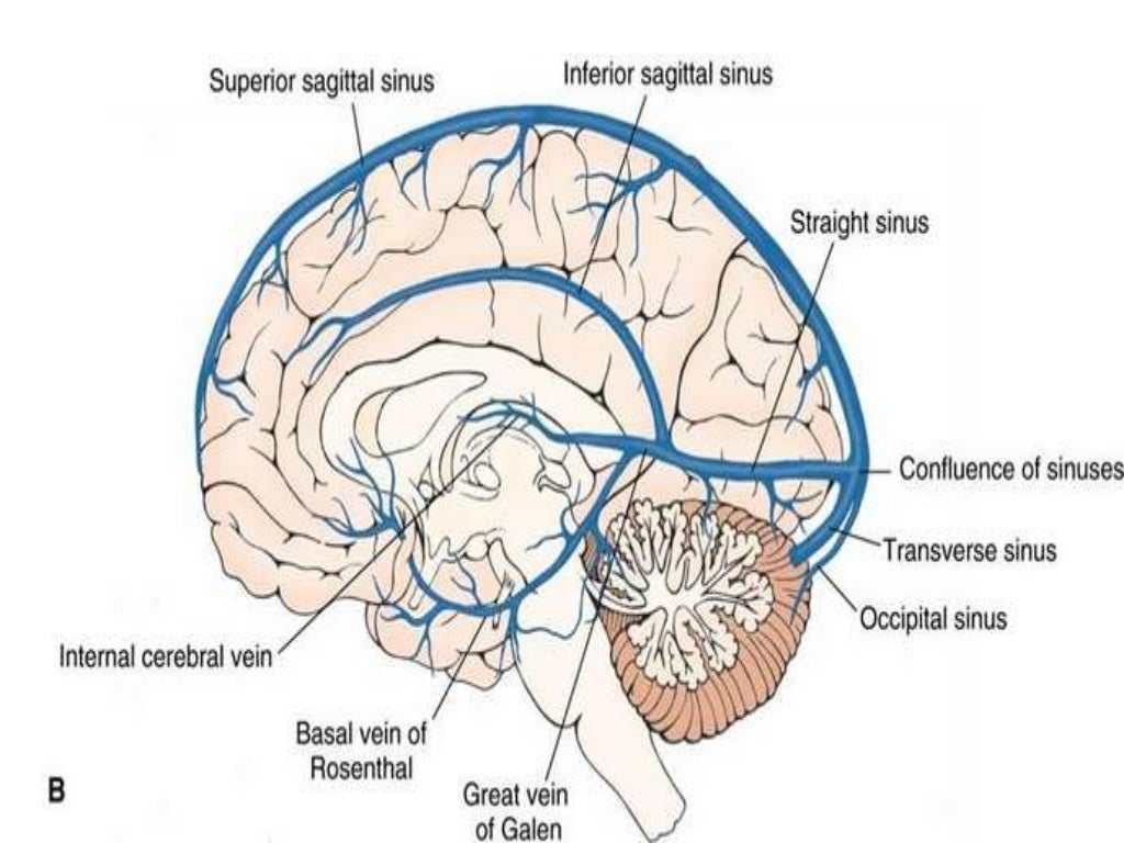 Imaging: Cortical Vein Thrombosis