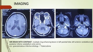 Differential diagnosis for ring enchancing lesion in brain | PPTX